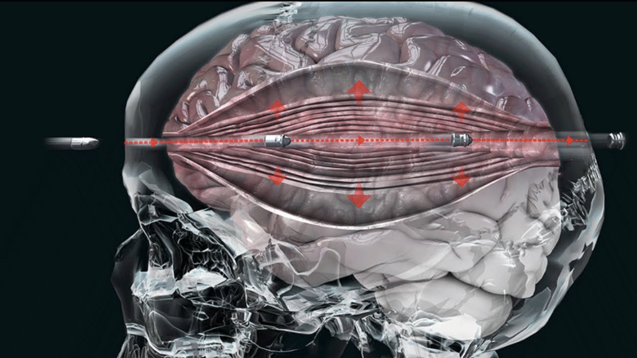 10 people who became geniuses after brain damage - The Mind Voyager